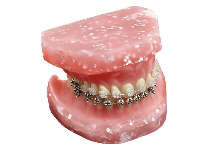 Types of Braces | SmartClip™ Self-Ligating Braces | Lucan Orthodontics